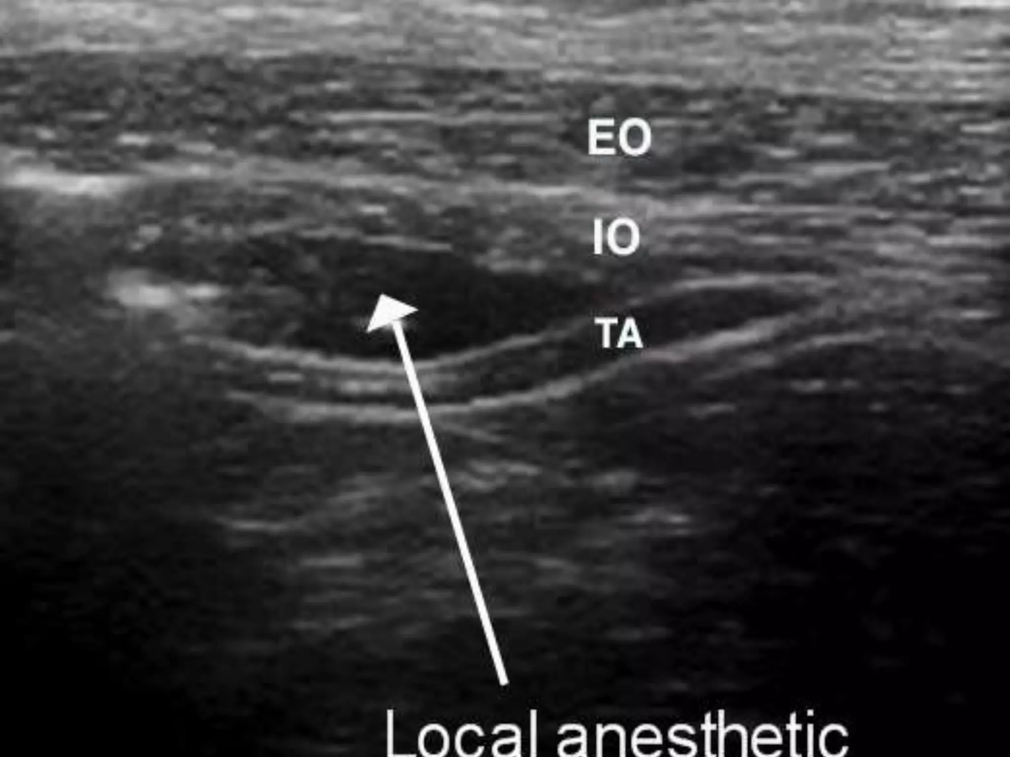 Ultrasound Guided Transversus Abdominis Plane (TAP) Block | PPT