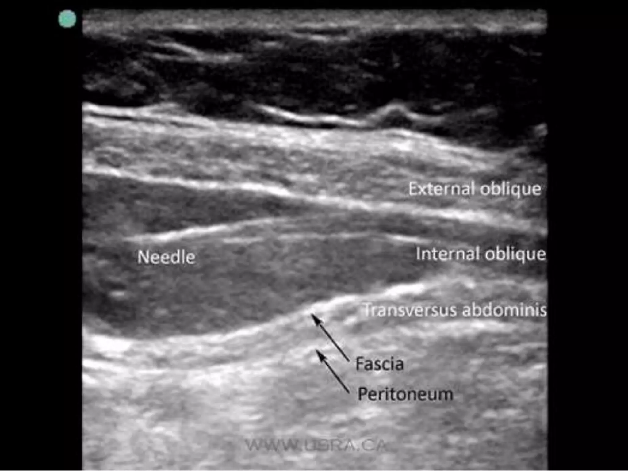 Ultrasound Guided Transversus Abdominis Plane (TAP) Block | PPT