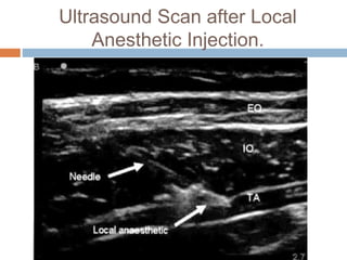 Ultrasound Guided Transversus Abdominis Plane (TAP) Block | PPTX