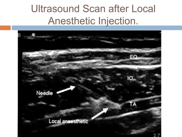 Ultrasound Guided Transversus Abdominis Plane (TAP) Block | PPTX