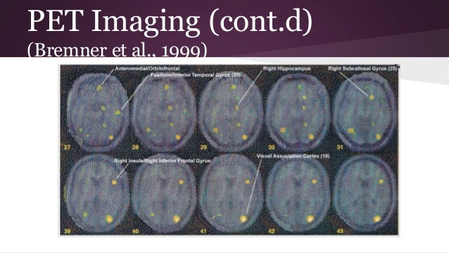 PTSD (Brain Imaging) Spring 2015