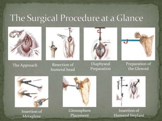 Reverse Total Shoulder Replacement, Final | PPTX