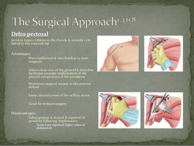 Reverse Total Shoulder Replacement, Final