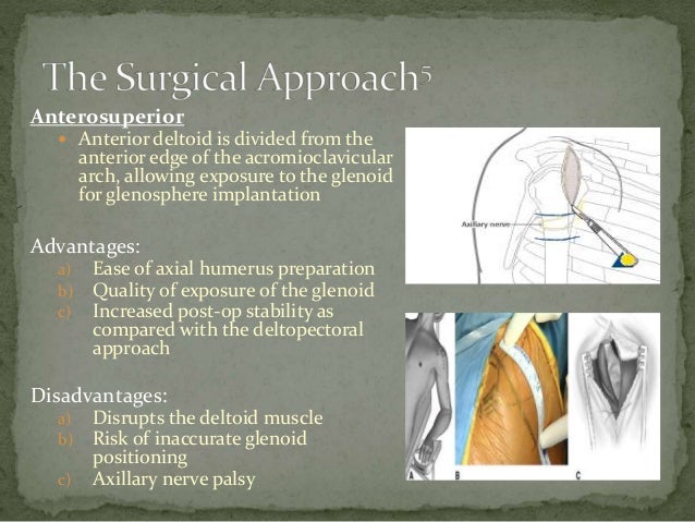 Reverse Total Shoulder Replacement, Final