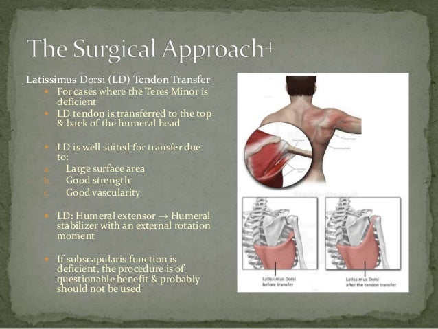 Reverse Total Shoulder Replacement, Final