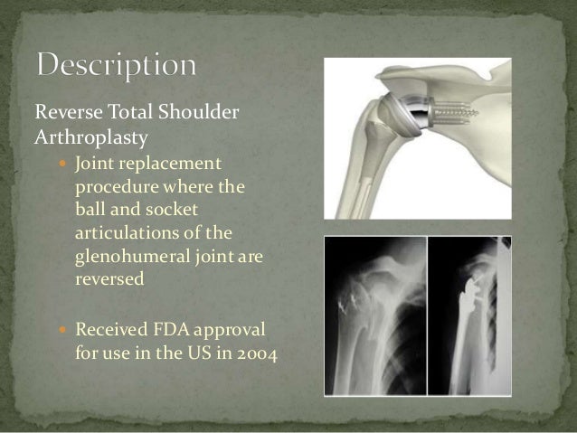 Reverse Total Shoulder Replacement, Final