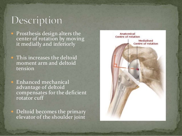 Reverse Total Shoulder Replacement, Final