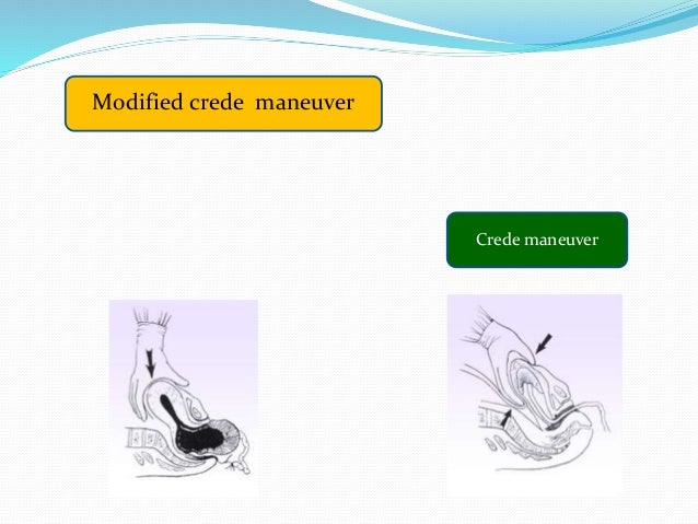 006 management of the third stage of labor