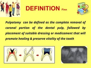 pulpotomy in endo work simplify and know | PPT