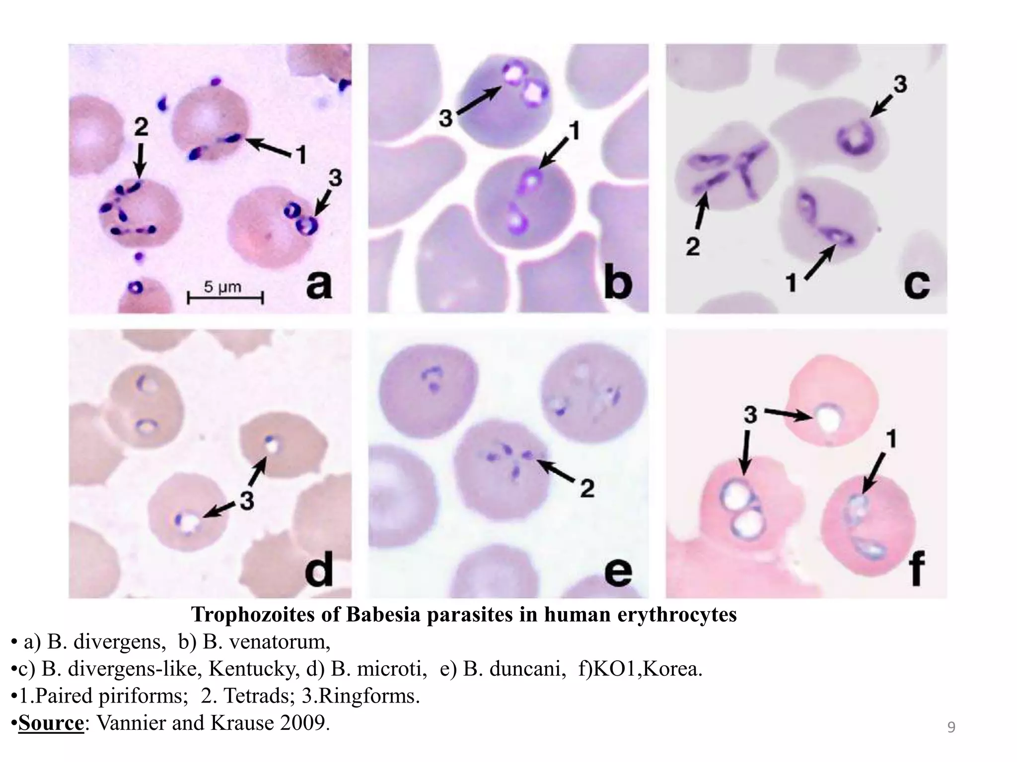 Malaria and Babesiosis co-infectionppt | PPTX