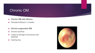 CONSERVATIVE MANAGEMENT OF OTITIS MEDIA final | PPTX