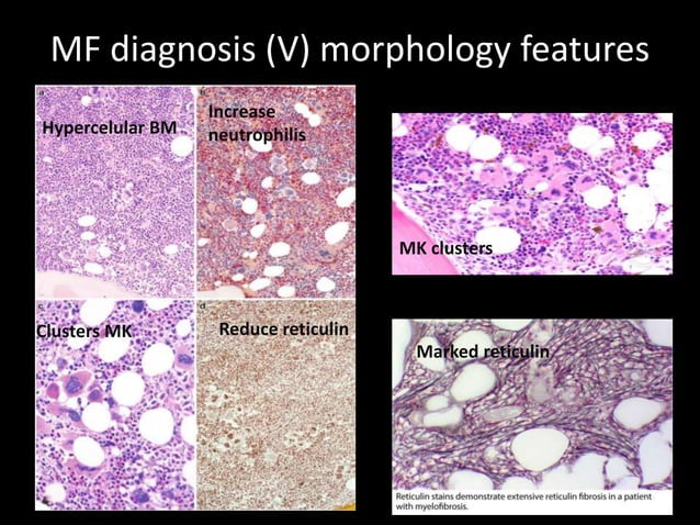 DIAGNOSIS AND MANAGEMENT OF MYELOPROLIFERATIVE NEOPLASMS | PPTX