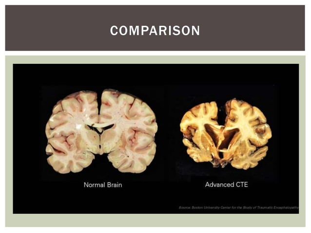 CTE Presentation Tara | PPTX | Brain and Nervous System Disorders ...