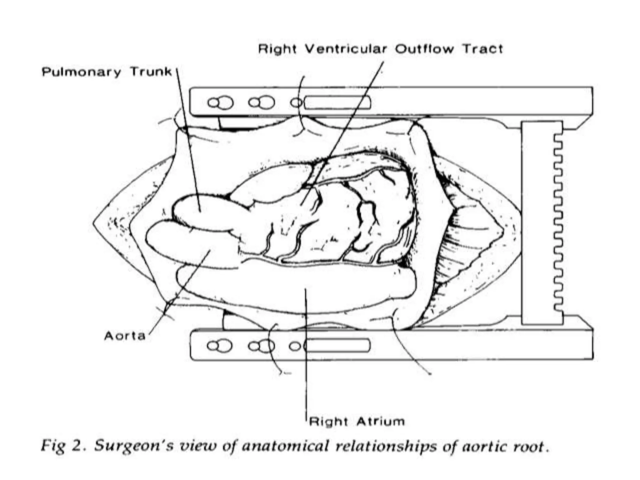 Aortic root anatomy DR NIKUNJ R SHEKHADA (MBBS,MS GEN SURG,DNB CTS SR ...