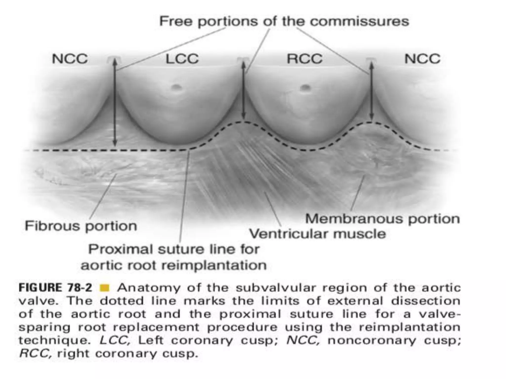 Aortic root anatomy DR NIKUNJ R SHEKHADA (MBBS,MS GEN SURG,DNB CTS SR ...