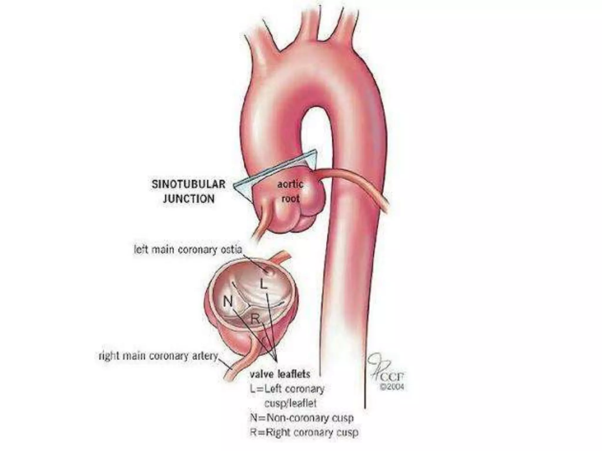 Aortic root anatomy DR NIKUNJ R SHEKHADA (MBBS,MS GEN SURG,DNB CTS SR ...