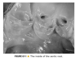 Aortic root anatomy DR NIKUNJ R SHEKHADA (MBBS,MS GEN SURG,DNB CTS SR ...