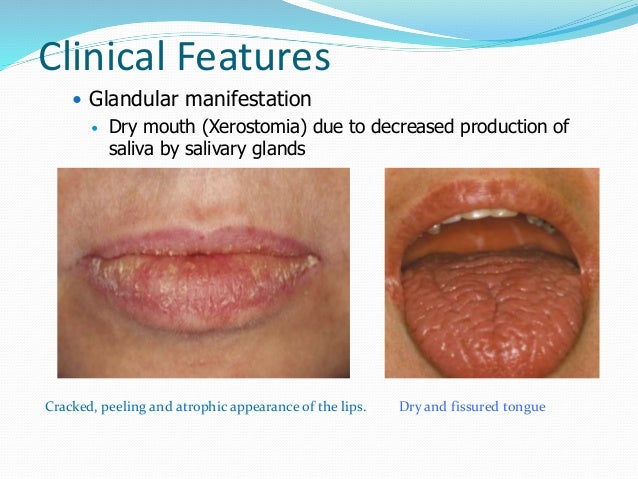 Sjogrens S Syndrome