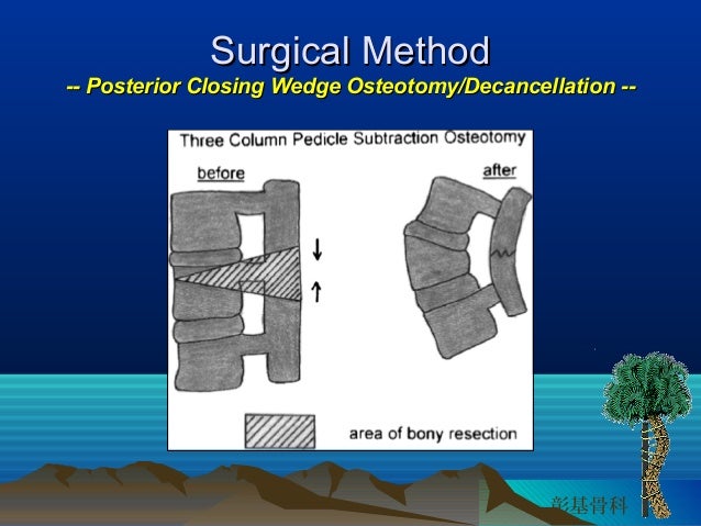 Posterior Closing Wedge Osteotomy, Decancellation and Instrumentation…