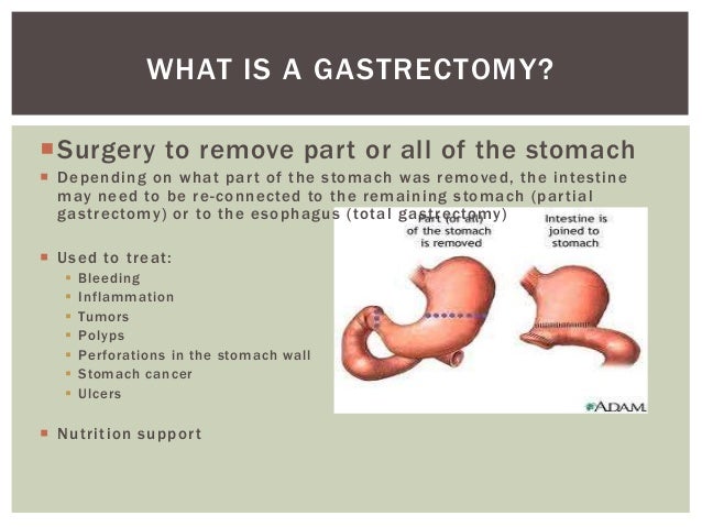Upper Partial Gastrectomy Diet - devilposts
