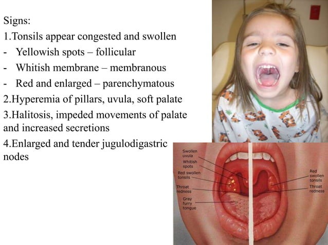 TONSILLITIS | PPTX | Ear, Nose and Throat Conditions | Diseases and ...