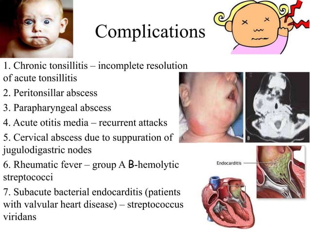 TONSILLITIS | PPTX | Ear, Nose and Throat Conditions | Diseases and ...