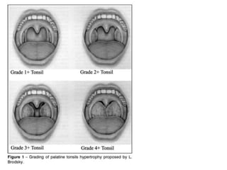 TONSILLITIS | PPTX