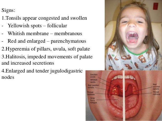 Normal Vs Swollen Tonsils