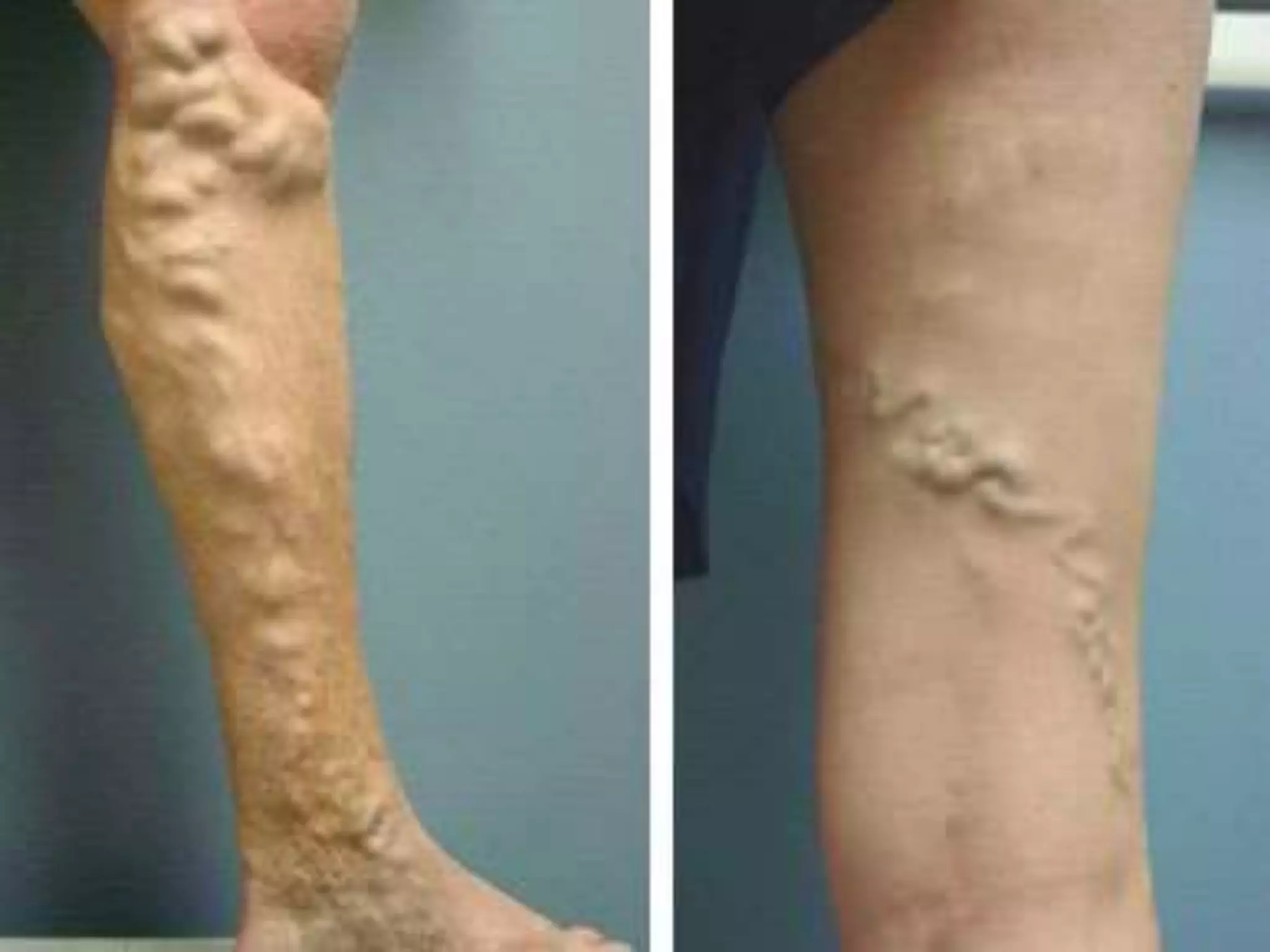 Venous Diseases, Varicose Veins | PPT