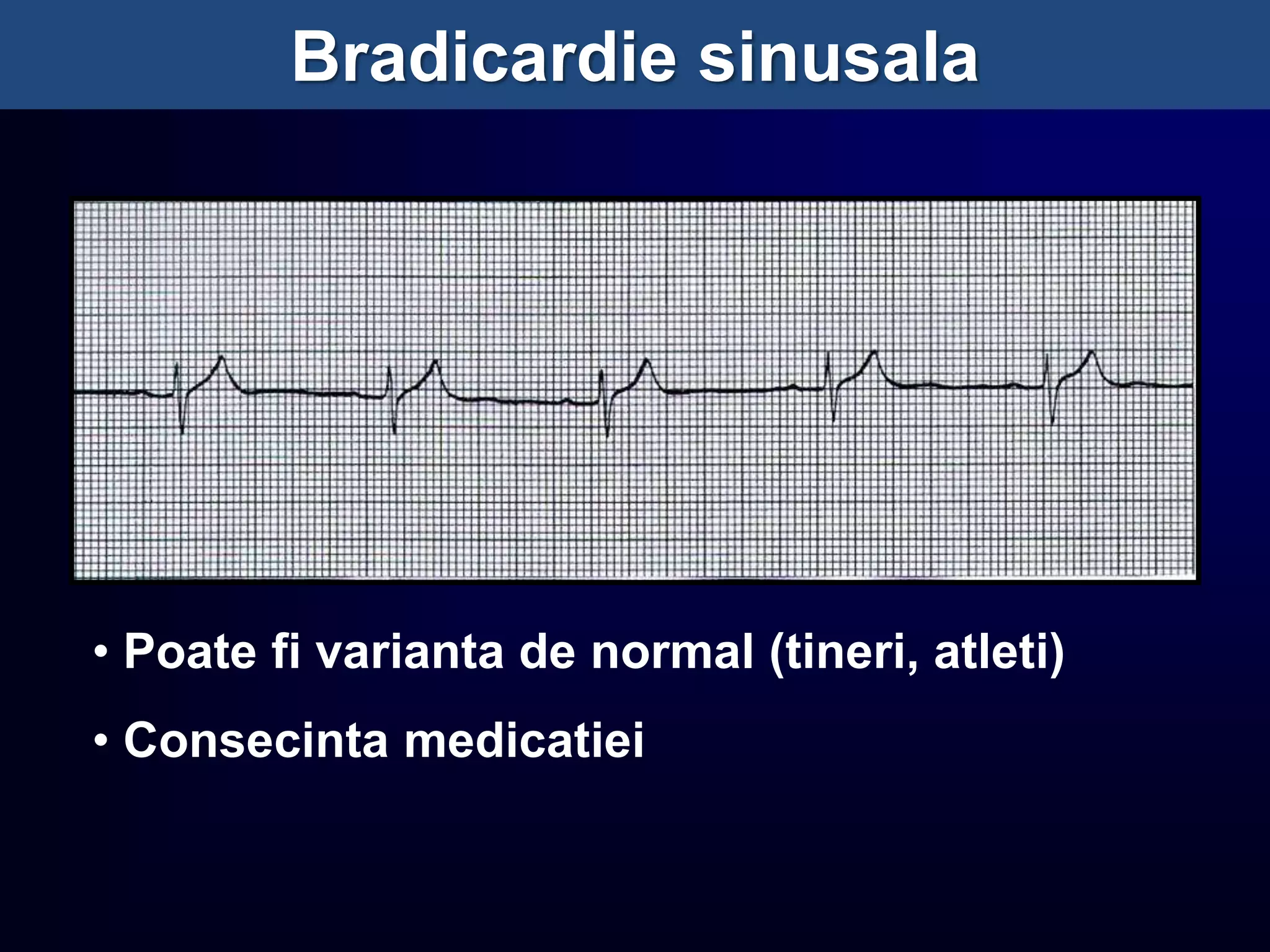 97693374-ECG-Curs-Aritmii.ppt