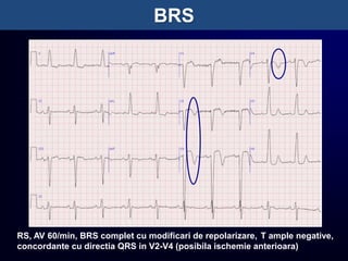 97693374-ECG-Curs-Aritmii.ppt