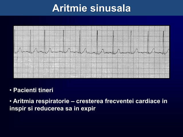 97693374-ECG-Curs-Aritmii.ppt