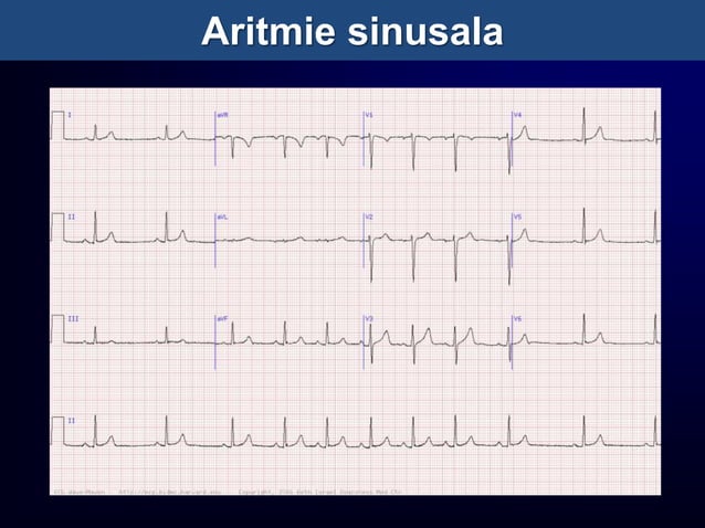 97693374-ECG-Curs-Aritmii.ppt