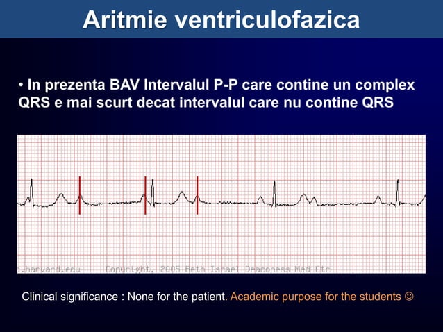 97693374-ECG-Curs-Aritmii.ppt