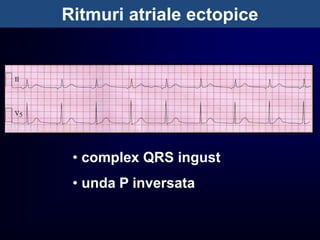 97693374-ECG-Curs-Aritmii.ppt