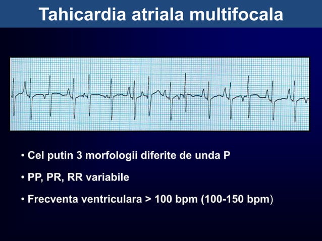 97693374-ECG-Curs-Aritmii.ppt