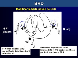97693374-ECG-Curs-Aritmii.ppt