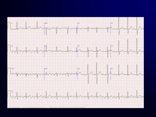 97693374-ECG-Curs-Aritmii.ppt
