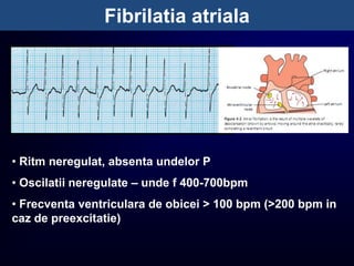 97693374-ECG-Curs-Aritmii.ppt