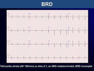 97693374-ECG-Curs-Aritmii.ppt