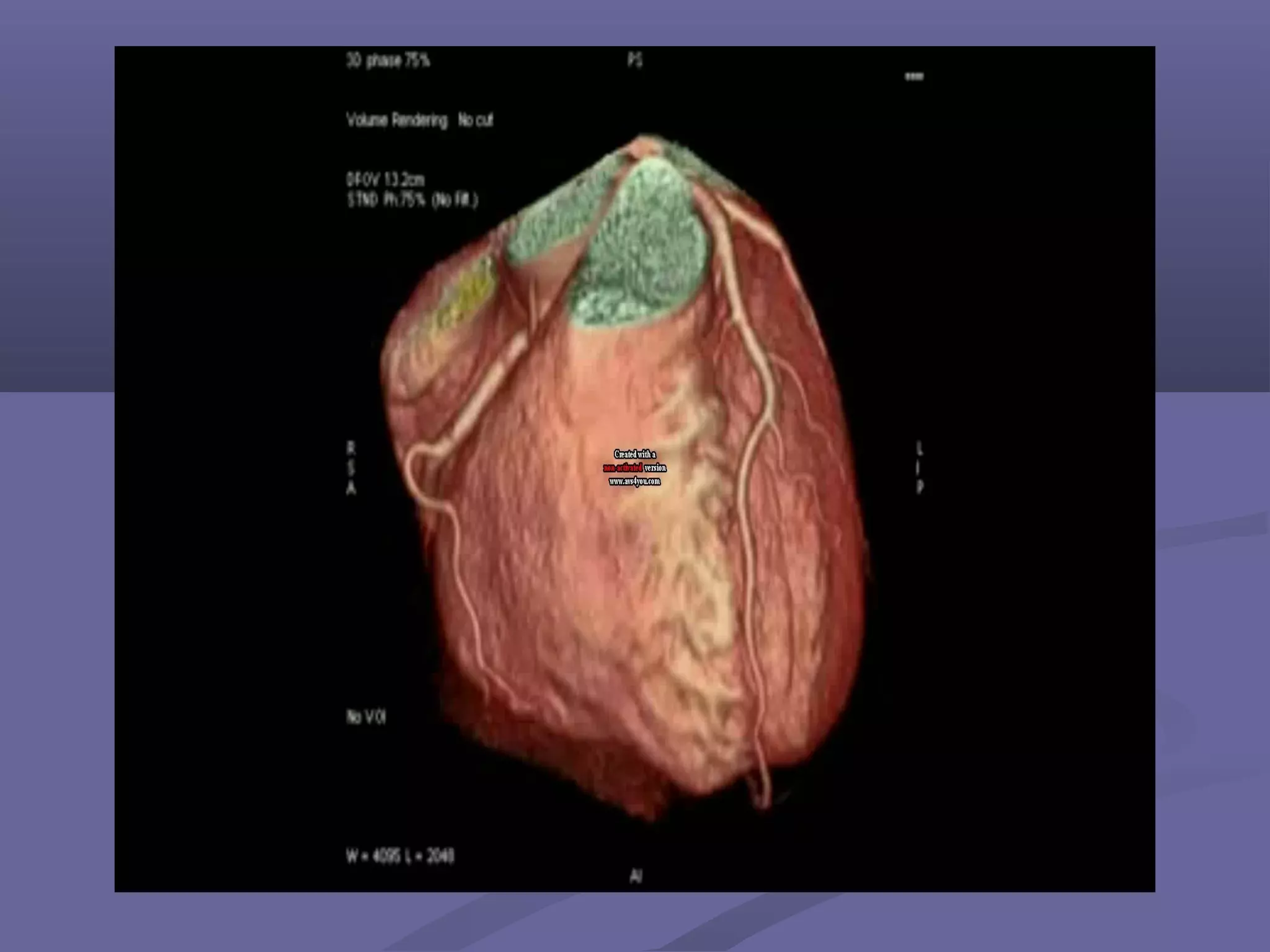 CARDIAC_CT_PRESENTATION | PPT
