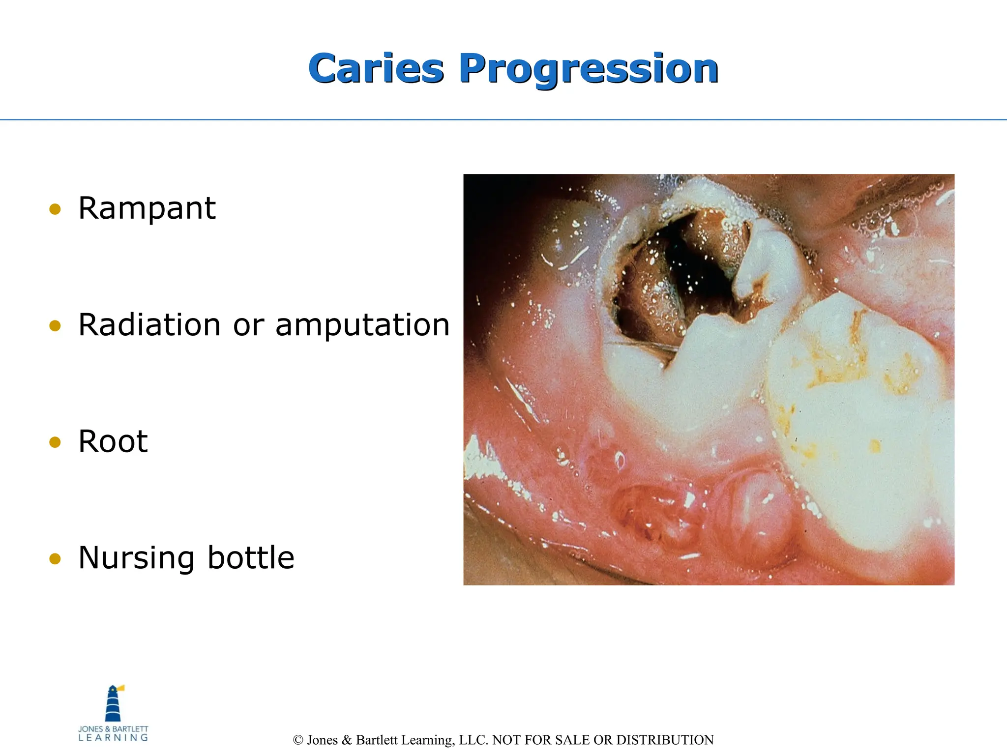 Dental Caries- Etiology, Description, Presentation. | PPT