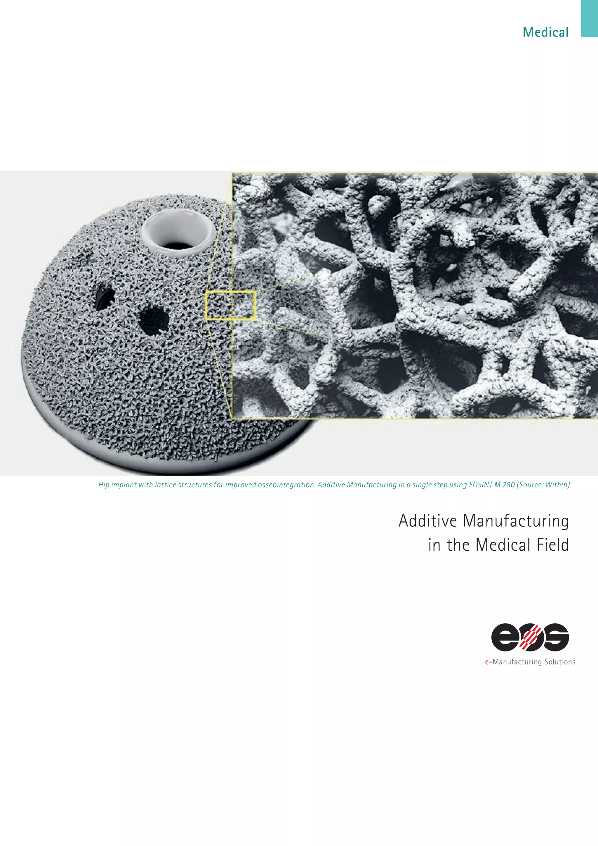 Additive Manufacturing in the Medical Field -EOS | PDF