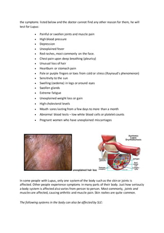 SYSTEMIC LUPUS ERYTHEMATOSIS - THESIS | DOCX