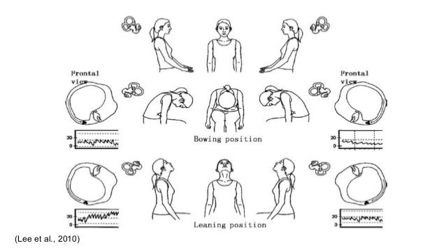 Vestibular Rehabilitation