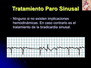 bloqueos sinoauriculares y auriculoventriculares | PPTX