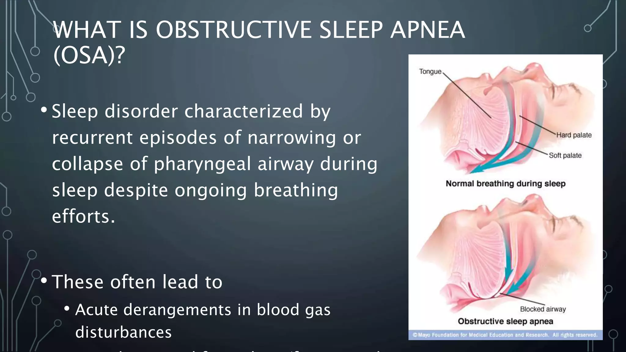 Dental management of sleep apnea | PPTX