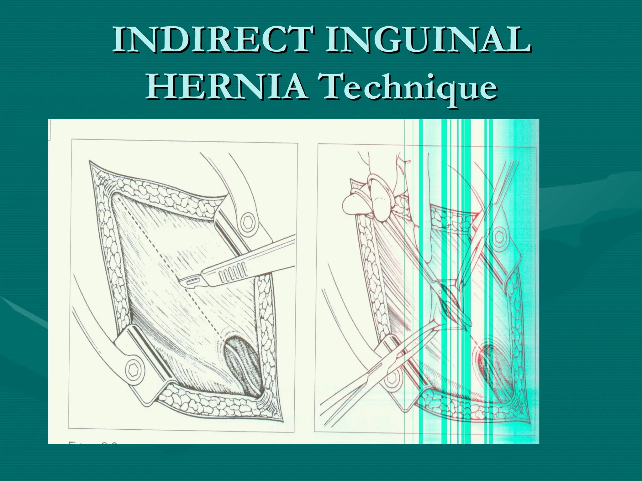 Abdominal wall hernia git system definition | PPT