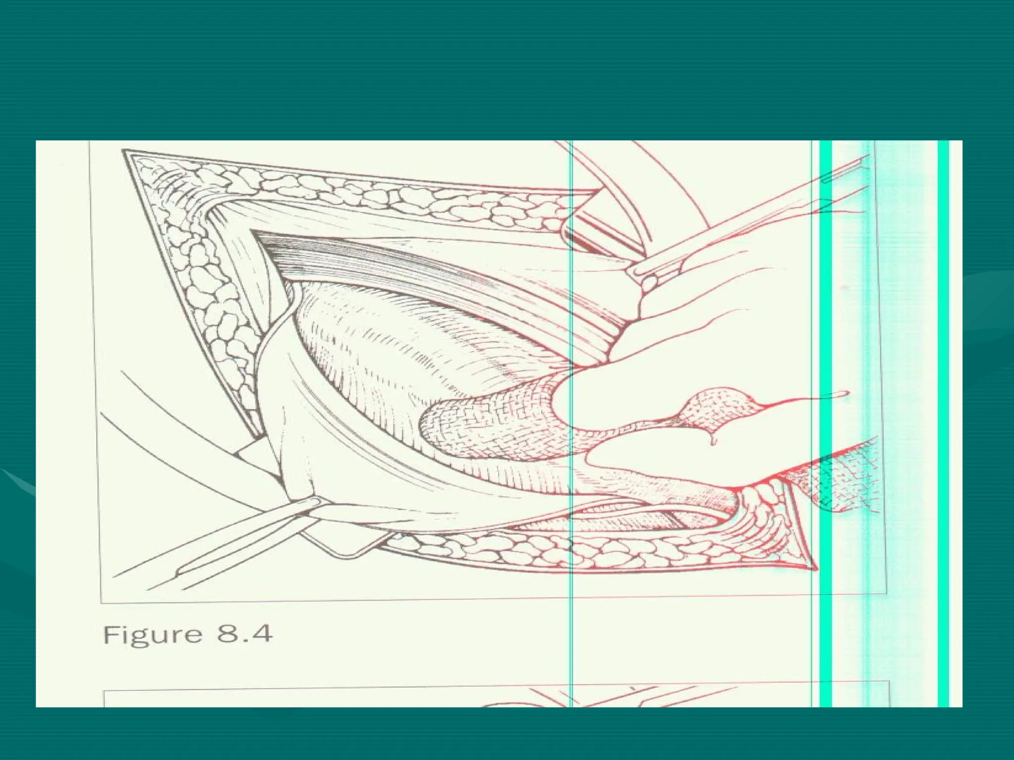 Abdominal wall hernia git system definition | PPT