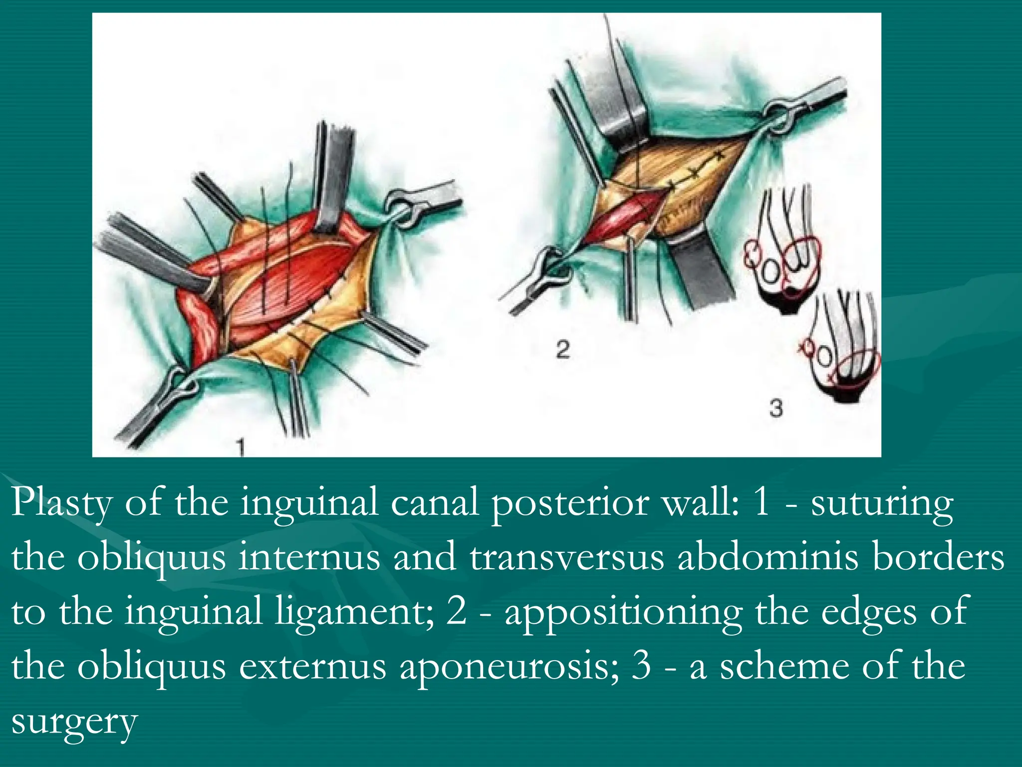 Abdominal wall hernia git system definition | PPT